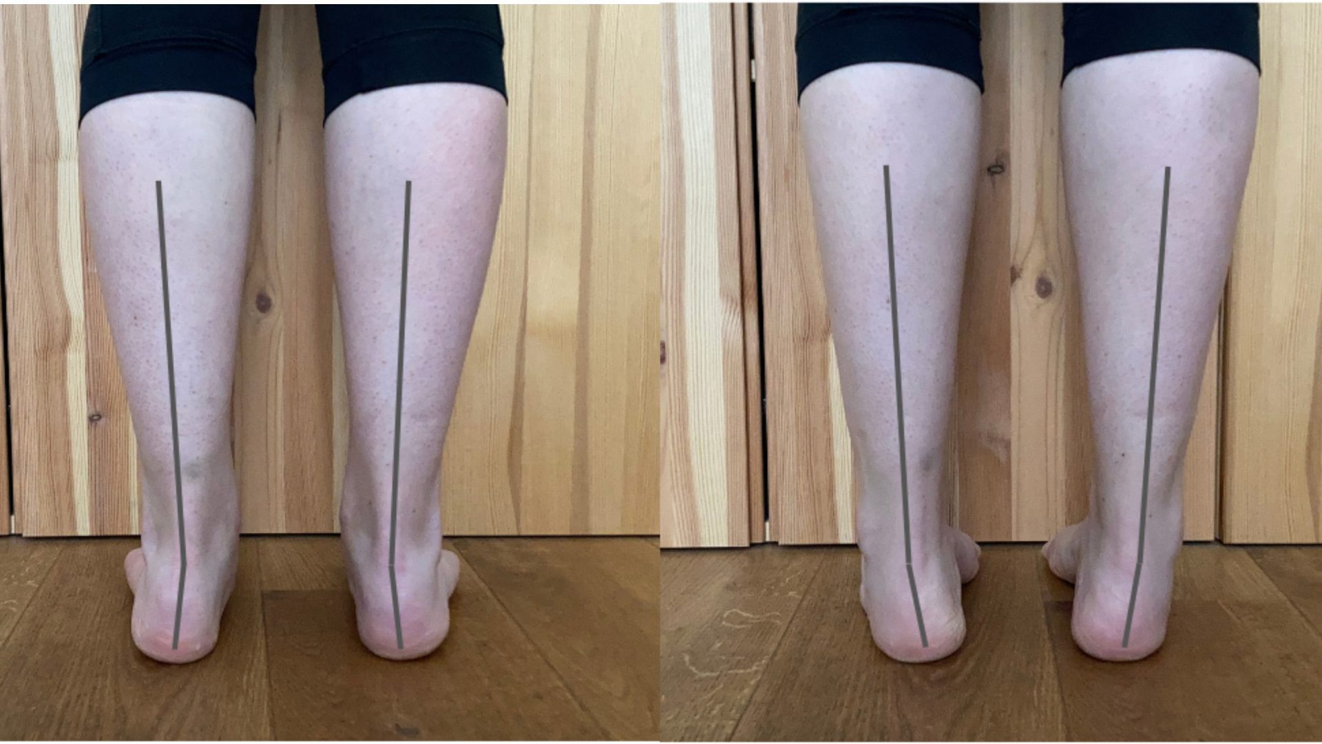 Der Knickfuß - co-physio